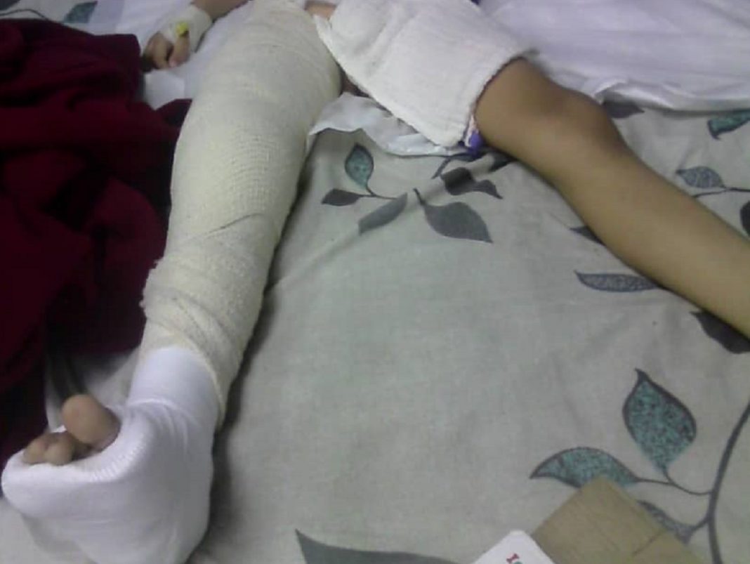 Servicio P blico Ni o Con Fractura De F mur Requiere De Ayuda Econ mica